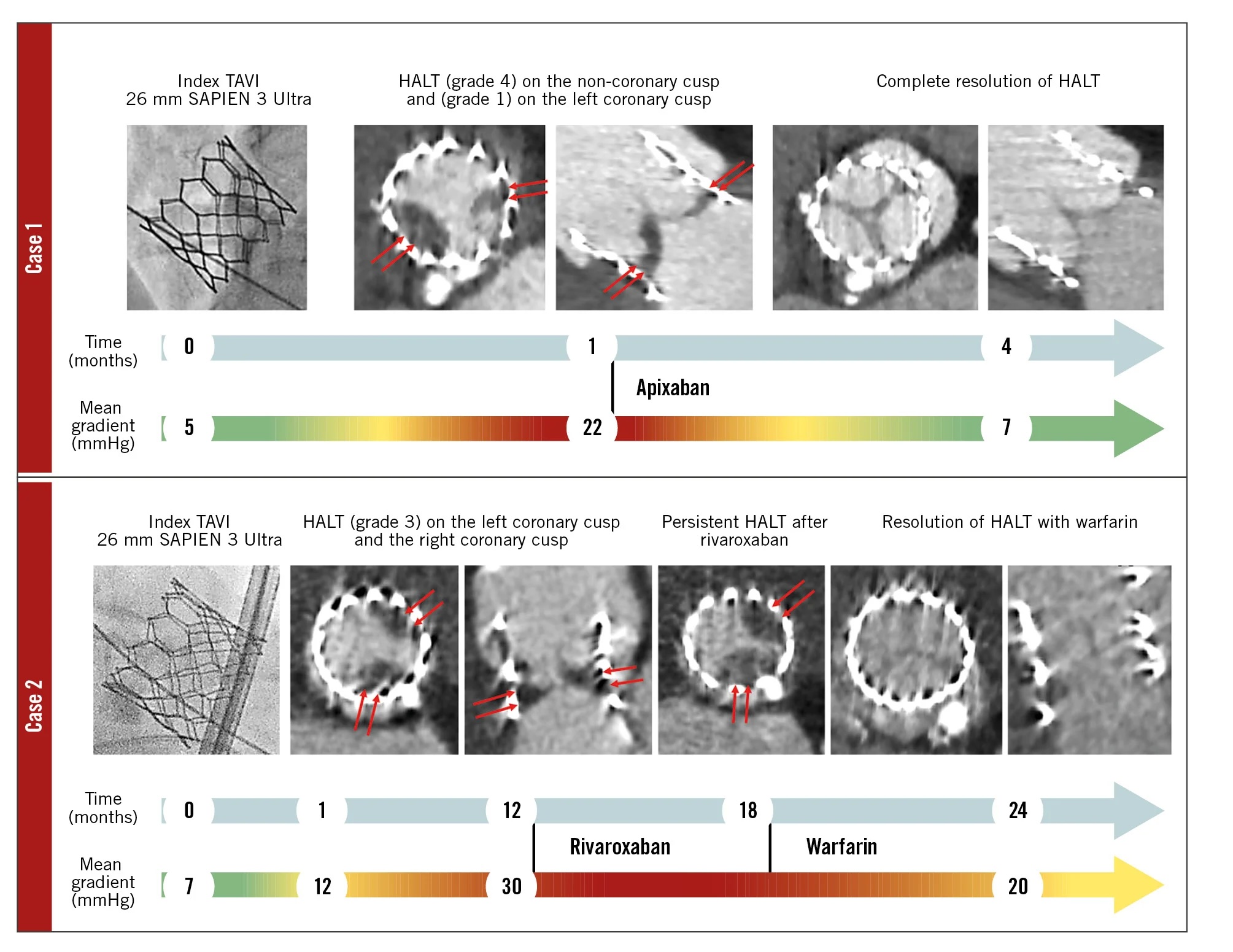 EuroIntervention | Your reference journal for coronary, valvular and ...